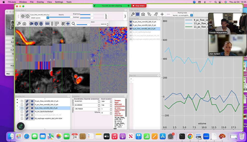 Usin Edge Impulse for PC-MRA study for identifying ROI-pulsatility ...